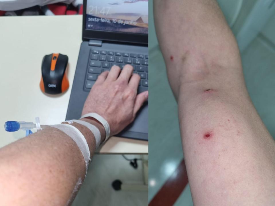 Varíola dos macacos: "Contei 60 feridas", diz brasileiro diagnosticado