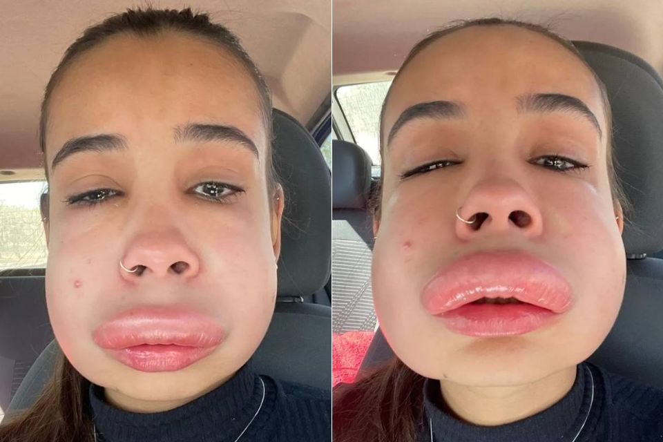 Estudante tem reação alérgica bizarra ao reverter preenchimento labial ... Estudante tem reação alérgica bizarra ao reverter preenchimento labial ...