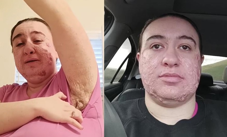 Mulher Com Doença Rara Que Causa Lesões Na Pele “me Sinto Nojenta