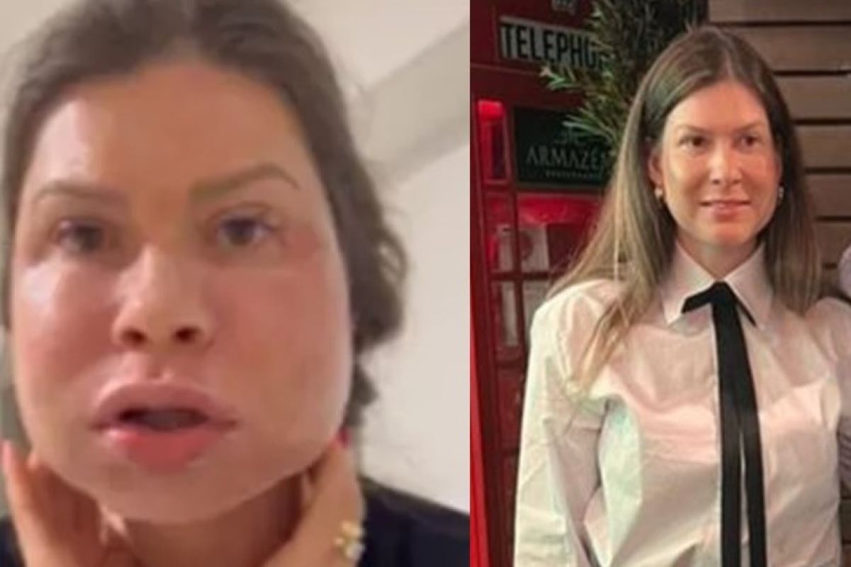 Veja antes e depois de mulher que teve o rosto deformado em clínica