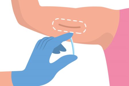 Implanon passa a ser obrigatório em planos de saúde hoje
