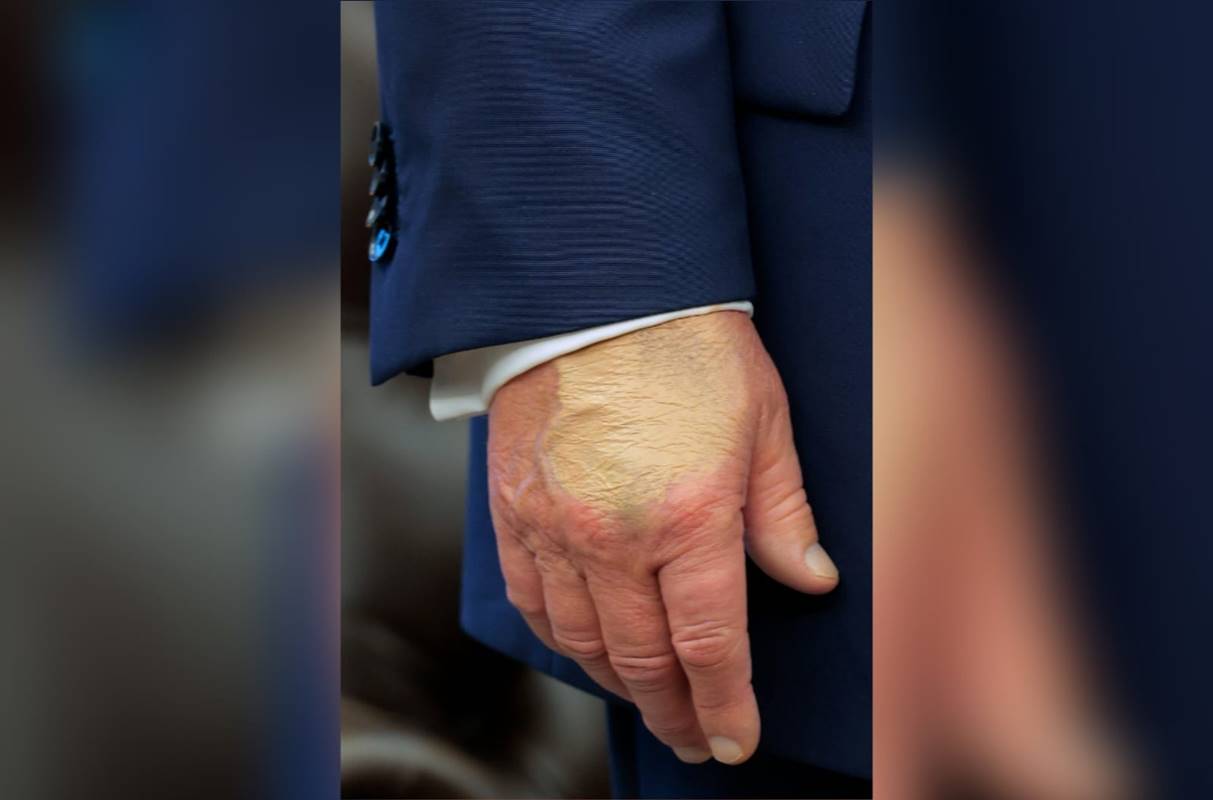 Após insuficiência venosa crônica, Trump aparece com maquiagem na mão